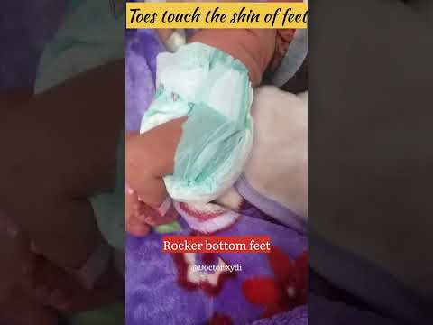 Rocker Bottom Foot Baby