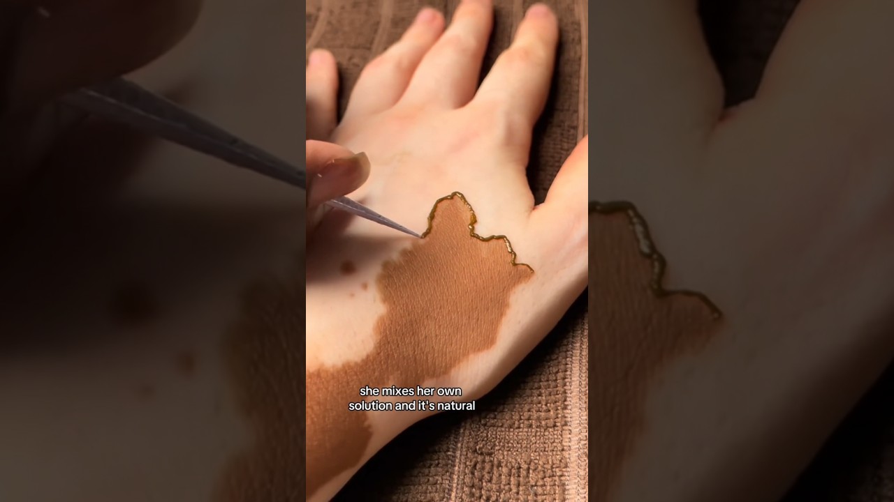 Trying Henna on vitiligo