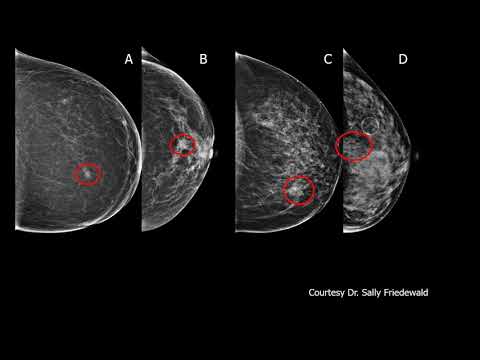Screening Algorithms in Dense Breasts