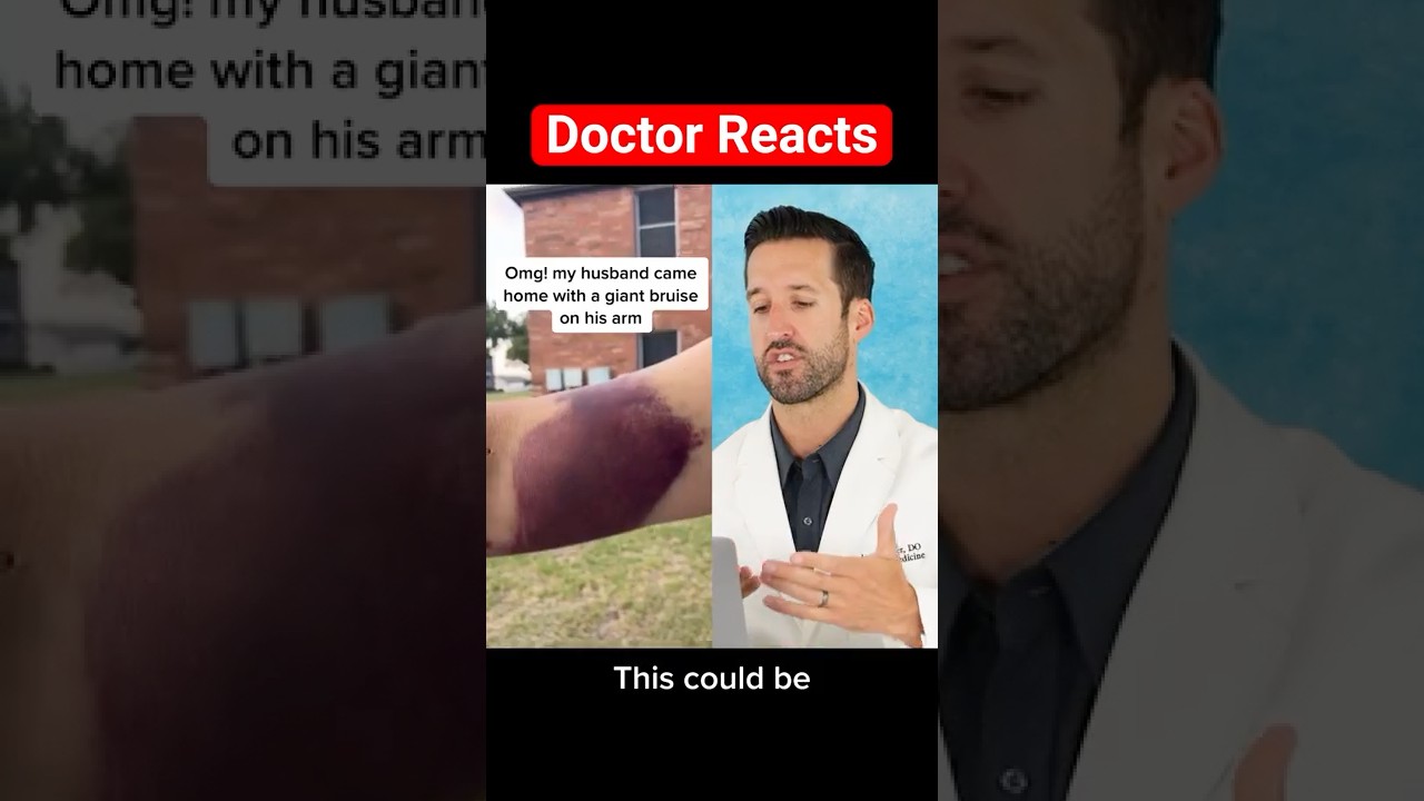 ER Doctor REACTS to World's Largest Bruise