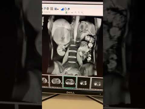 Adrenal Mass MRI View