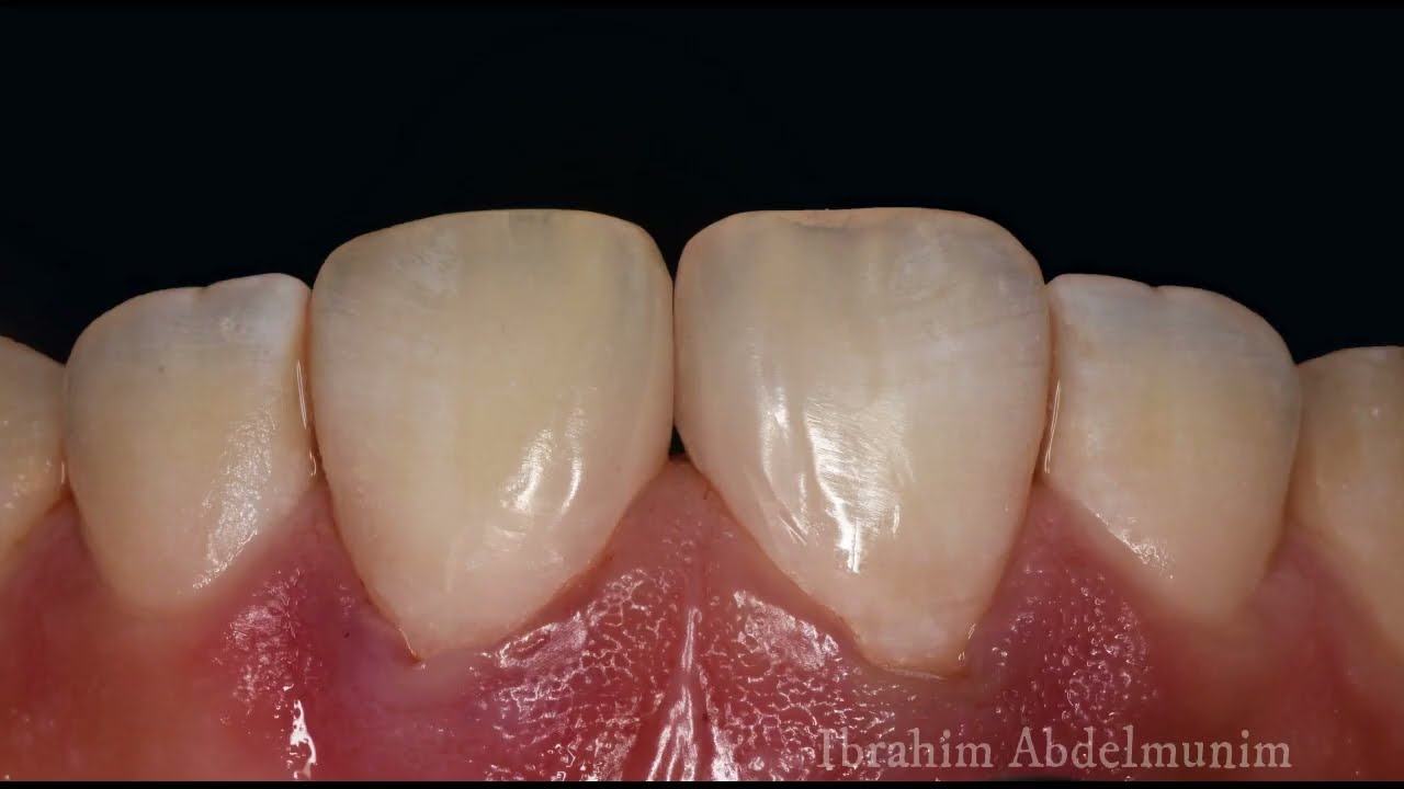 diastema closure  using direct composite resin