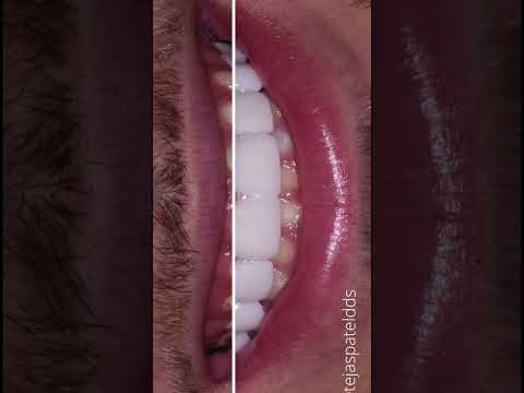 10 upper porcelain veneers by Dr. Tejas Patel. Subscribe to learn more about Veneers #shorts