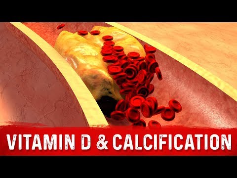 Vitamin D and Coronary Artery Calcification Explained by Dr.Berg