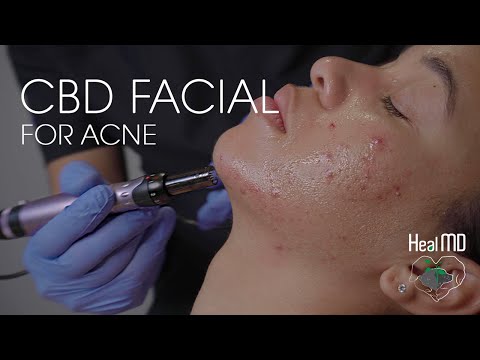 Can CBD Get Rid of Acne?