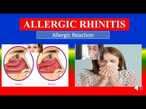 ALLERGIC RHINITIS - Definition, types, causes, pathophysiology, signs & symptoms, medicine