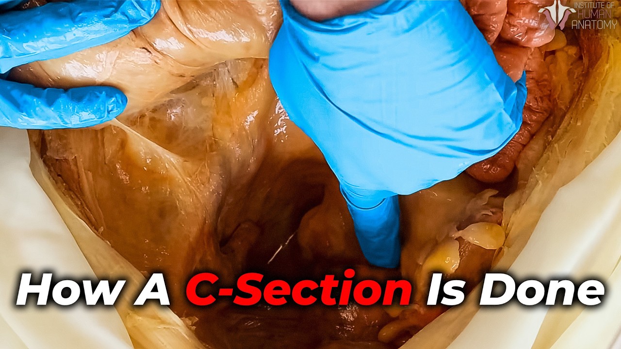 What Actually Happens During a C-Section?