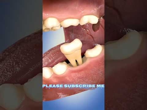 I Tried The Most Expensive Dental Implants