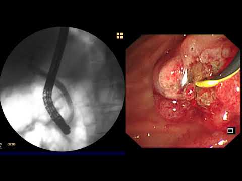THE CURSE OF THE SPINK1: HEREDITARY PANCREATITIS