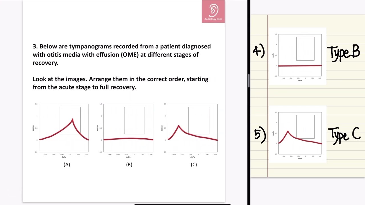[Quiz] Tympanometry Basics