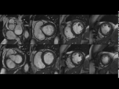 Arrhythmogenic Cardiomyopathy
