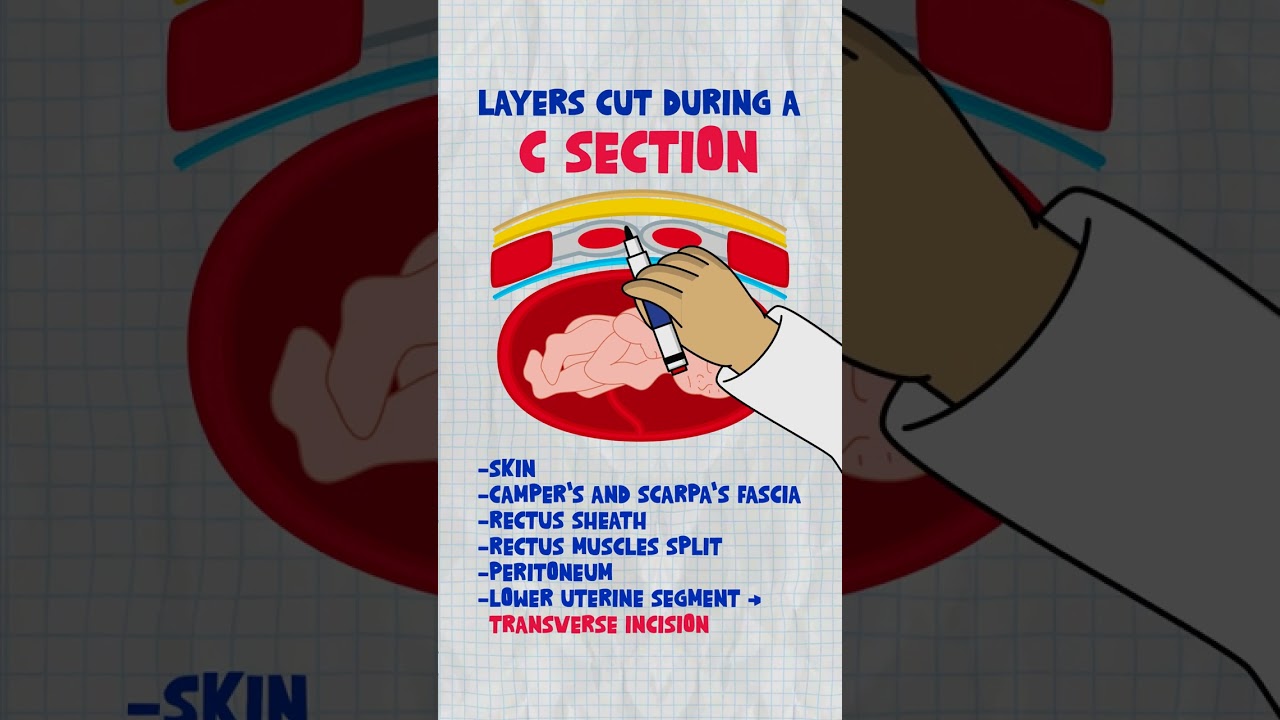 Emergency C-Section Explained in 60s 🚨 | Step 2 OB-GYN High-Yield Mnemonic