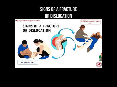 Signs of a fracture or dislocation #fracture #dislocation #legpain #trauma