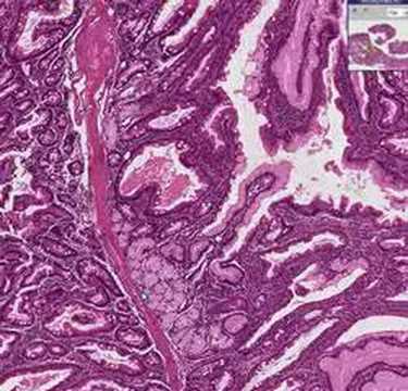 Histopathology Small intestine, duodenum--Peutz-Jeghers poly