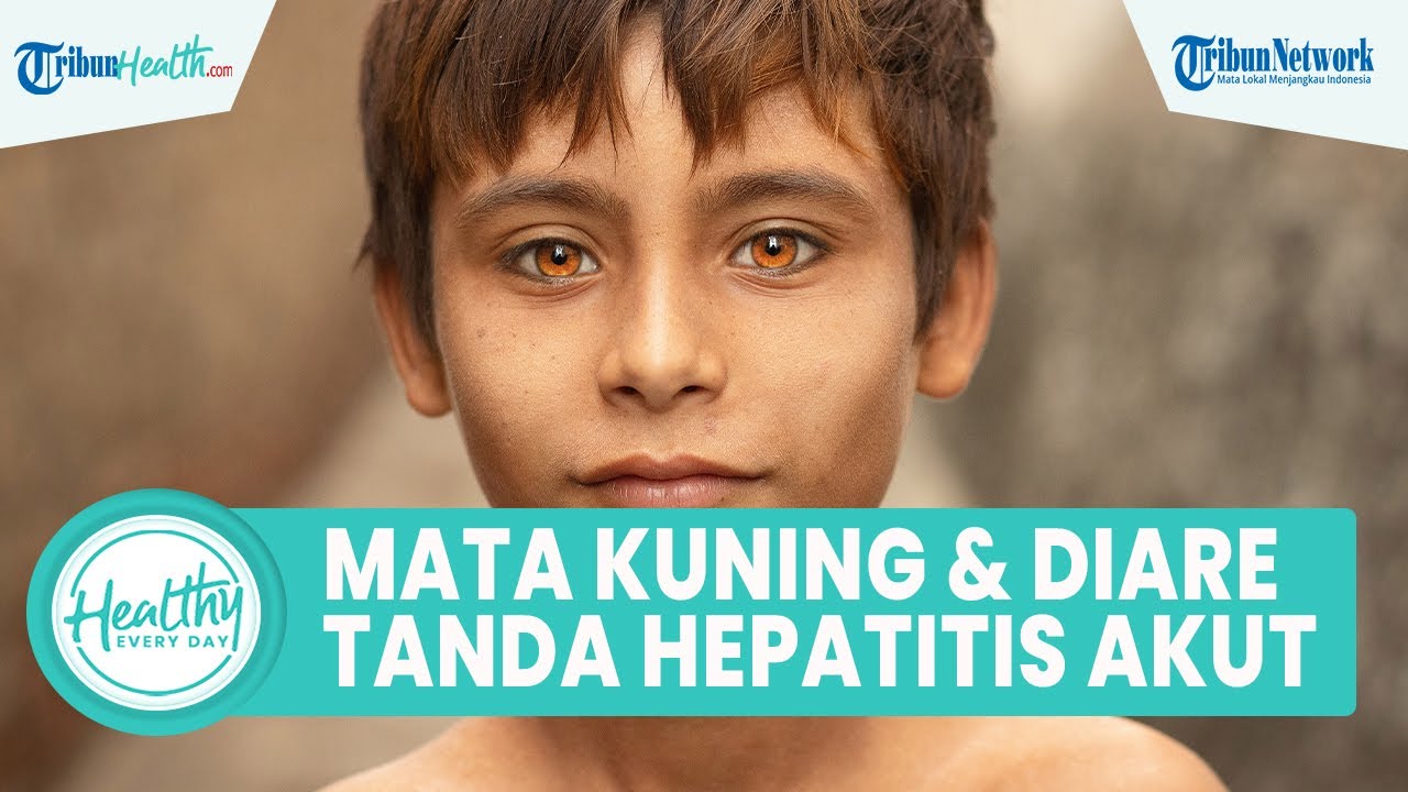 Waspadai Anak Alami Diare hingga Mata Kuning Bisa Jadi Tanda Hepatitis ...