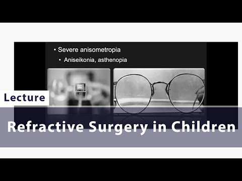 Refractive Surgery in Children