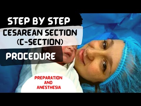 C-SECTION STEP BY STEP PROCEDURE || DETAILED || WHAT TO KNOW #howto
