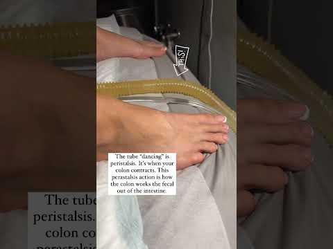 Colon peristalsis during a live colonic irrigation