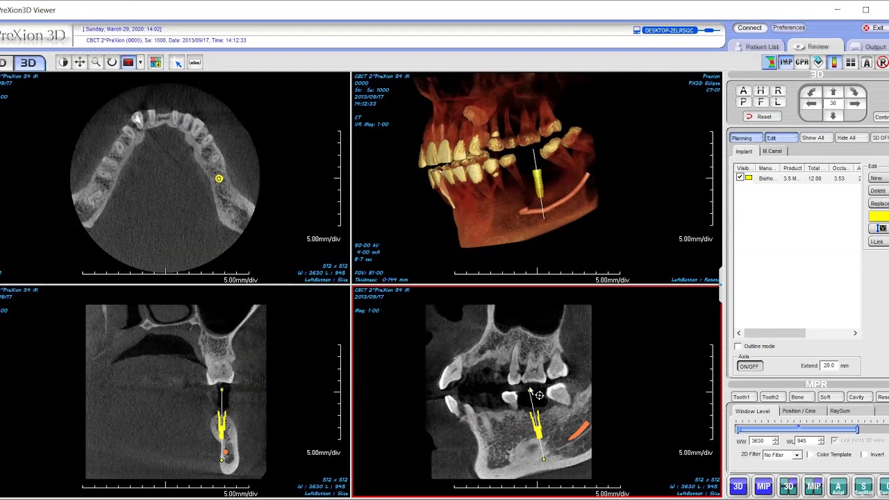 PreXion Training Tips: Virtual Implant Placement, Mandibular Canal Tracing