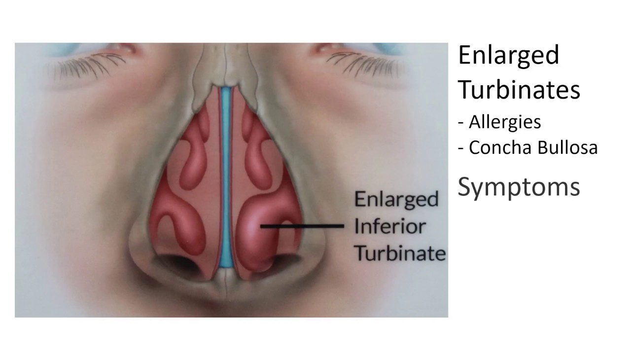 Enlarged Nasal Turbinates, Symptoms, and Treatment