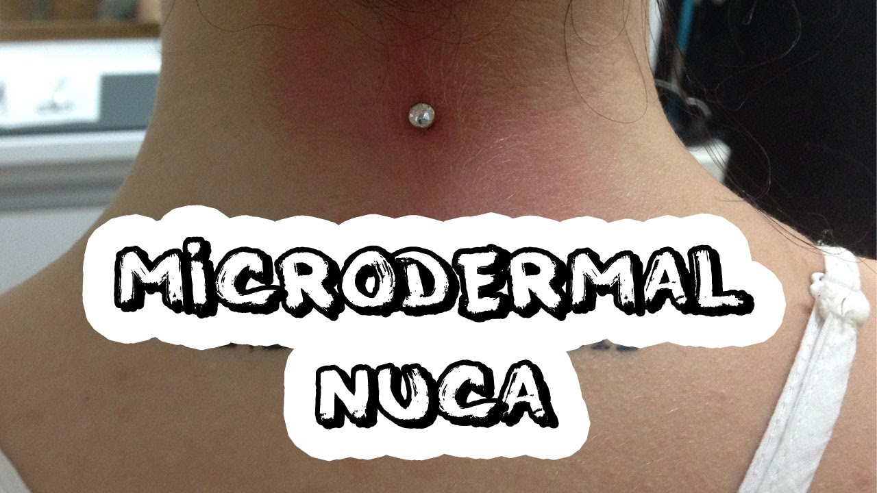 Microdermal na Nuca - Microdermal implants
