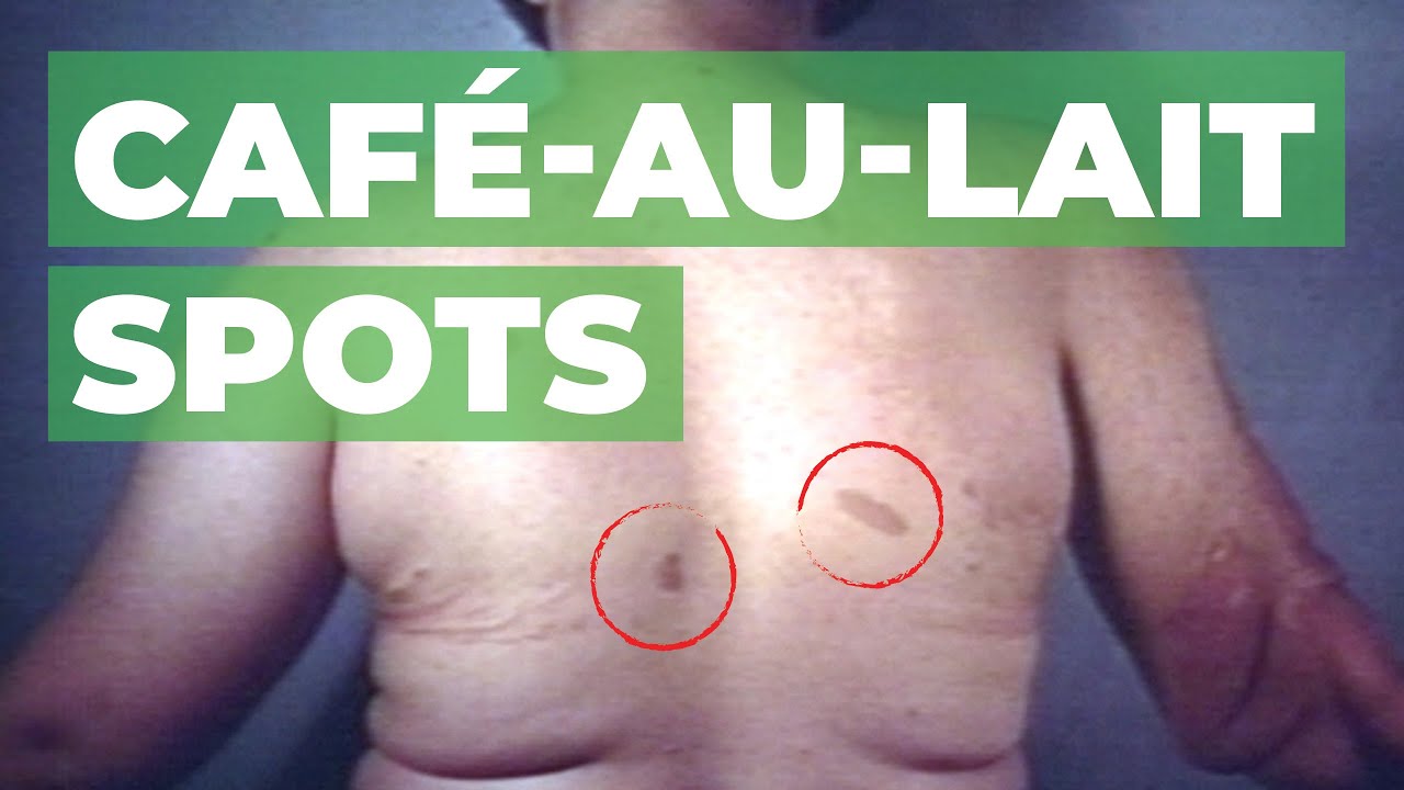 Can Cafe au lait Spots Appear Suddenly Tipseri can-cafe-au-lait-spots-appear-suddenly-tipseri