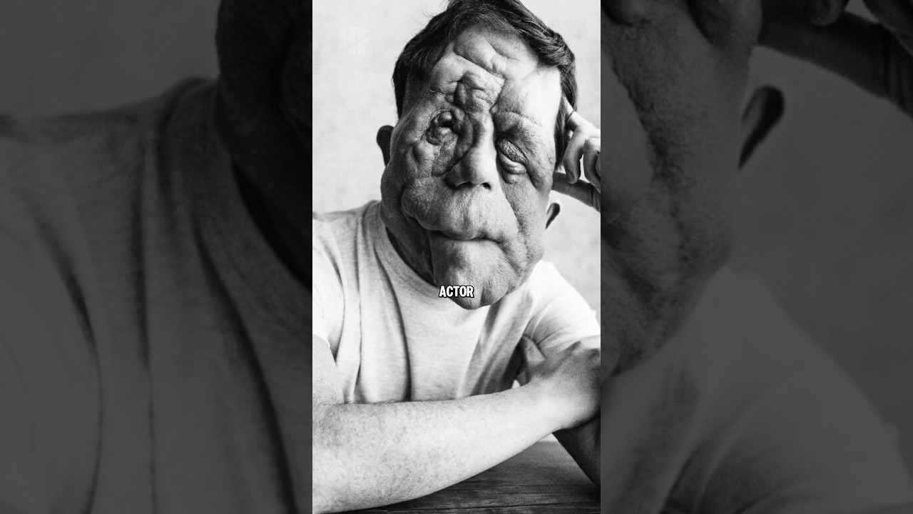 EL ACTOR CON NEUROFIBROMATOSIS QUE SE CONVIRTIO EN ESTRELLA DE HOLLYWOOD #hollywood #famosos #fyp