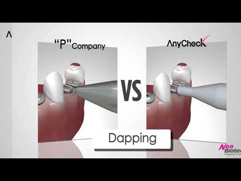 Implant Stability Tester│AnyCheck (by DMS Co., Ltd.)