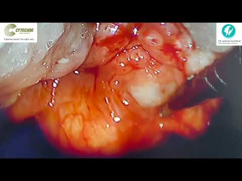 Valecullar cyst excised Trans orally with laser surgery