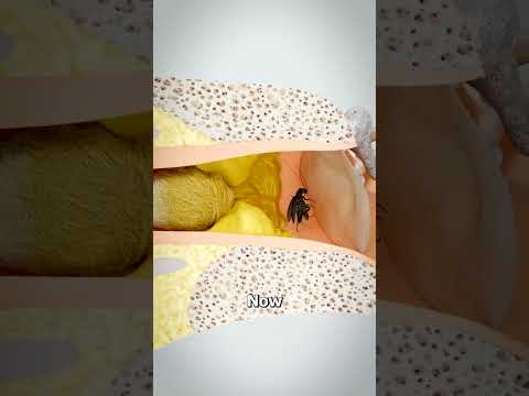 Why You Should Check Your Ears For Bugs 😨