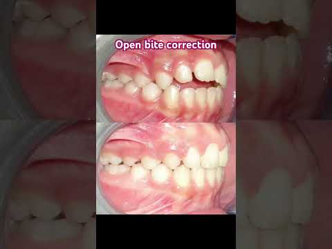 Openbite correction #dentist #smiledesigndental #dentistry #dentalartistry #yourhealth #orthodontist