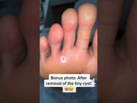 FOUND A WHITE PEARL IN A PATIENT'S FOOT?! #shorts