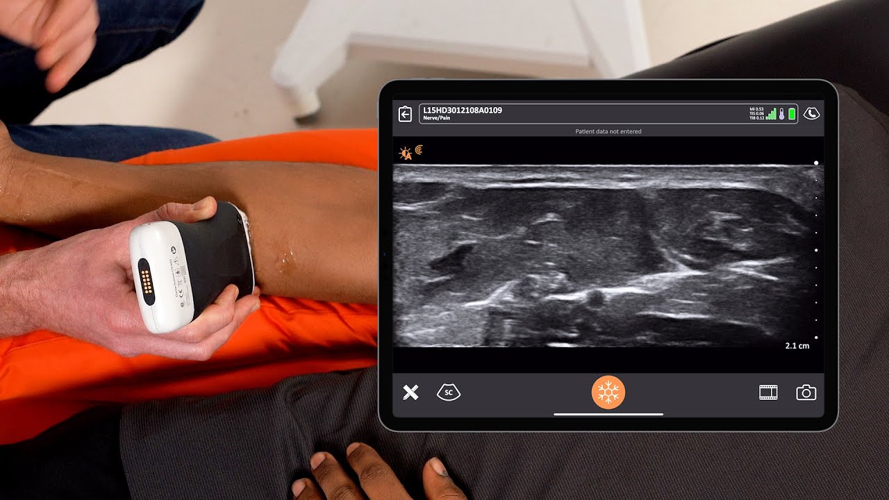 Scanning the Ulnar Nerve