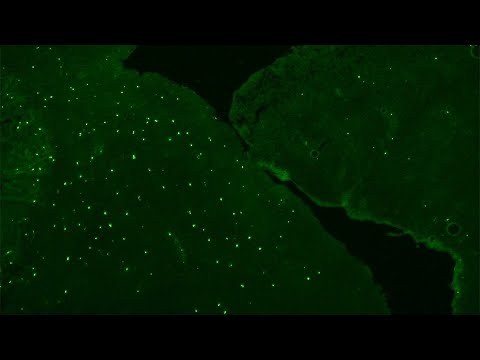 Kelch like protein 11 autoantibodies
