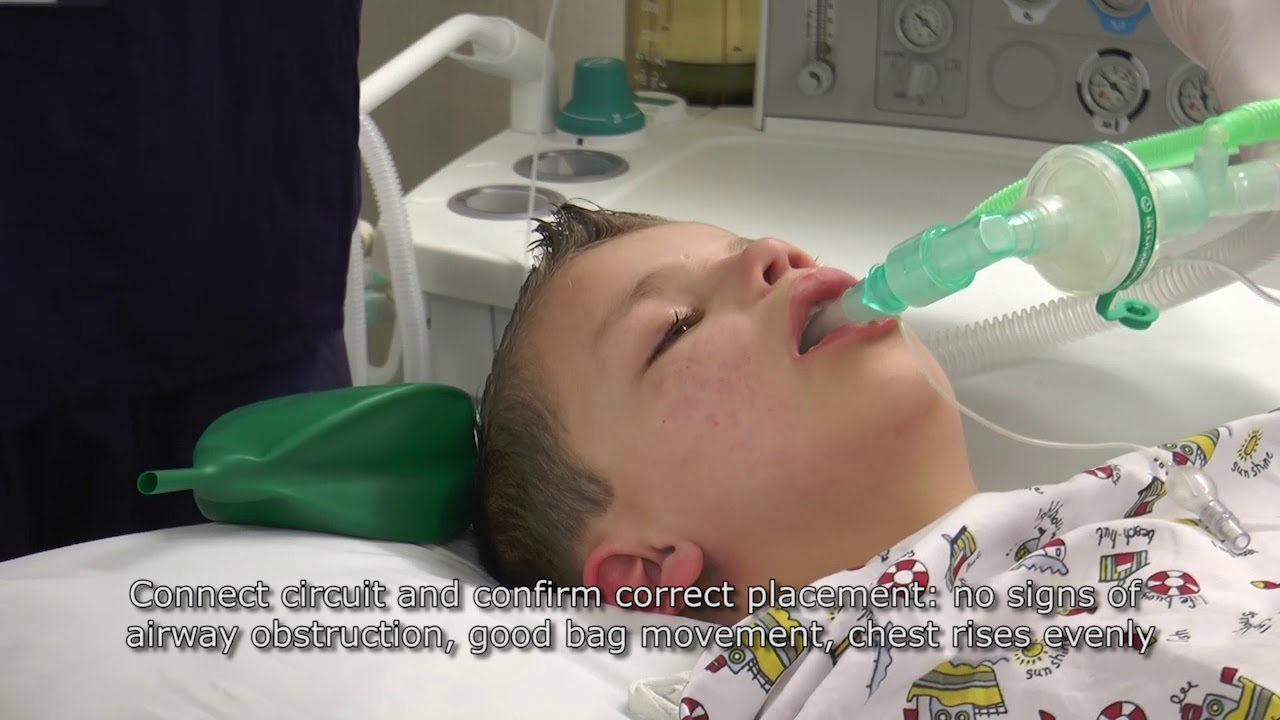Paediatric Anaesthetics: Chapter 2 -  LMA insertion (1)
