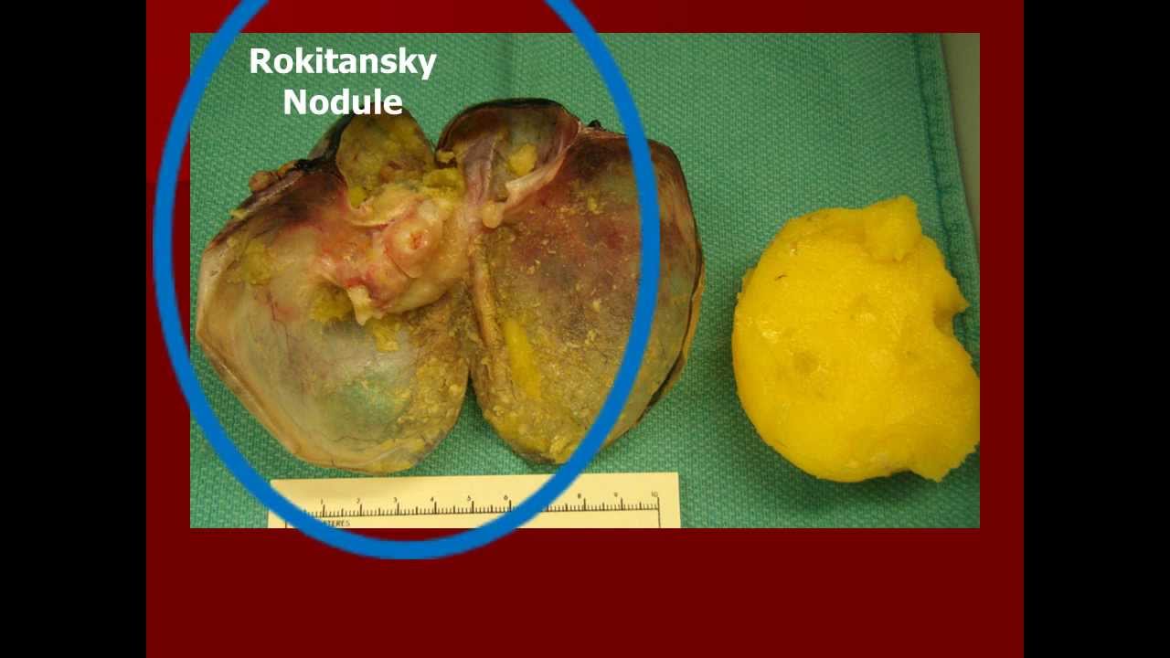 Mature Ovarian Teratoma (incidental)