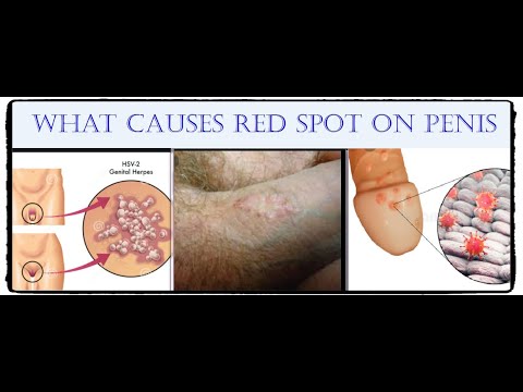 What Causes Red Spots on the Penis and How Are They Treated.البقع الحمراء على القصيب السبب والعلاج