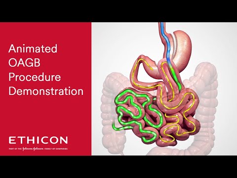 Bariatric Procedures – Bariatric Surgery Education