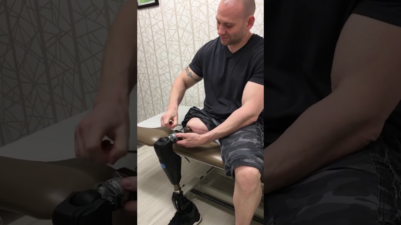 Osseointegration Limb Replacement Patient Jesse Levine | HSS