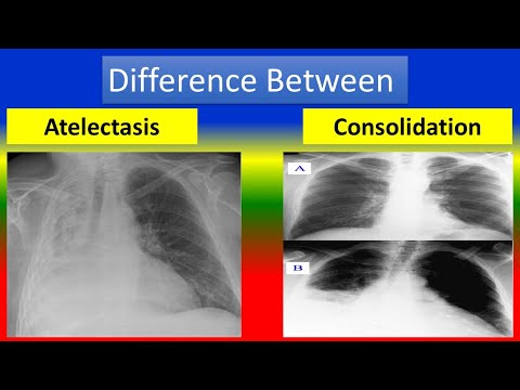 Difference between Atelectasis and Consolidation