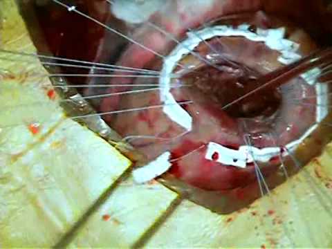 Heartmate II LVAD: Inflow Cannulation Technique. Arie Blitz, MD