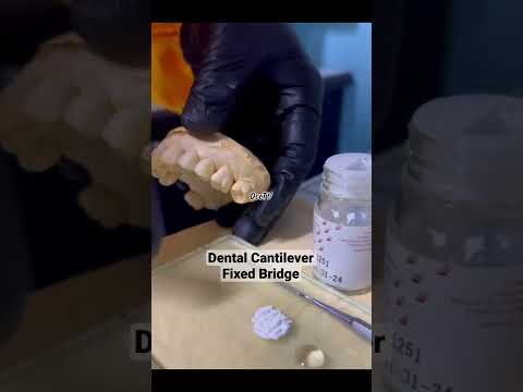 Cantilever Bridge! #dentist #dentalhealthcare #prosthodontics #shorts #fyp #fypã‚· #trending | DocTV