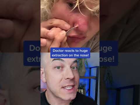 Doctor reacts to massive nose pimple extraction! #nosepimple #pimplepopper #dermreacts