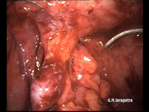 Laparoscopic reversal of Hartmann's resection - G. H. Ierapetra