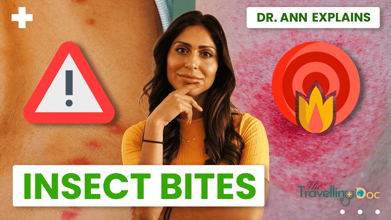 Insect Bites: How to Tell What Bit You (Pictures + When to Worry)#doctor #insectbite