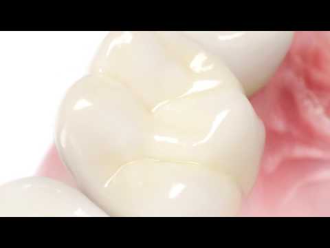 Elevate Your Restorations with Unparalleled Precision: The CEREC Crown Advantage