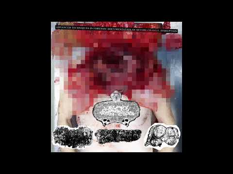 UxTxIxFxSxPxCx/Blenncardichromodacryexgenitohaemgene/IxOxDxFxLxWxTxDxAxPxRxOxAxDxOx/Ulcerating Tumor