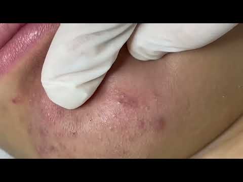 Each type of acne will have a different way of removing it. Gently and without causing damage #38