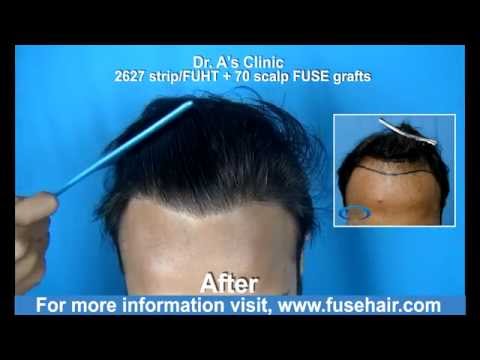 A82 -2627 strip FUHT + 70 scalp FUSE grafts (32 months update) - Dr. A's Clinic