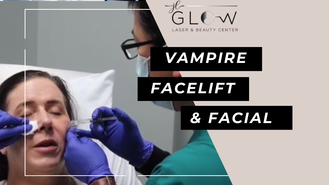 Vampire Facelift & Vampire Facial